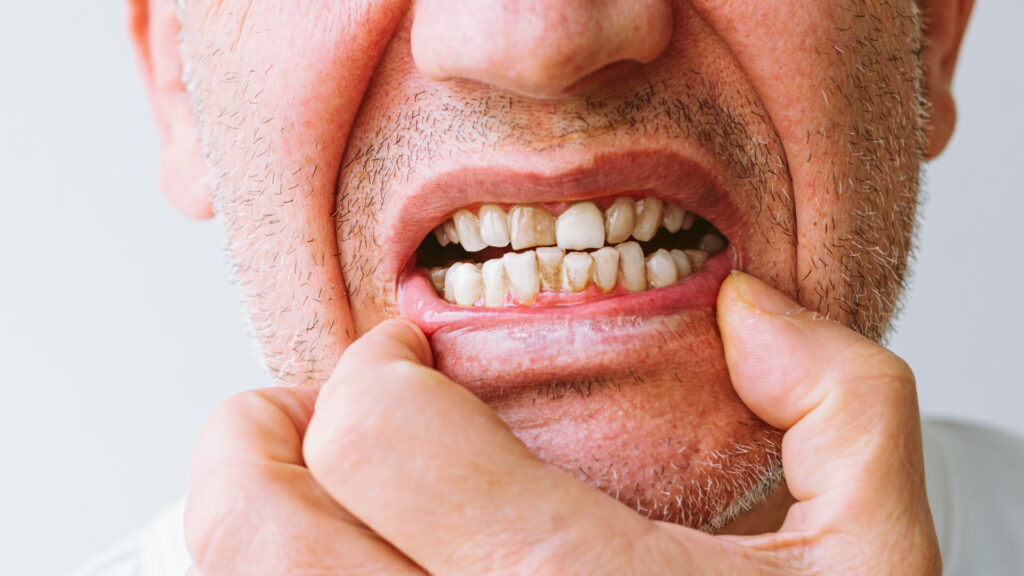 How Gum Disease Can Lead To Dental Pulpitis: Understanding The Connection